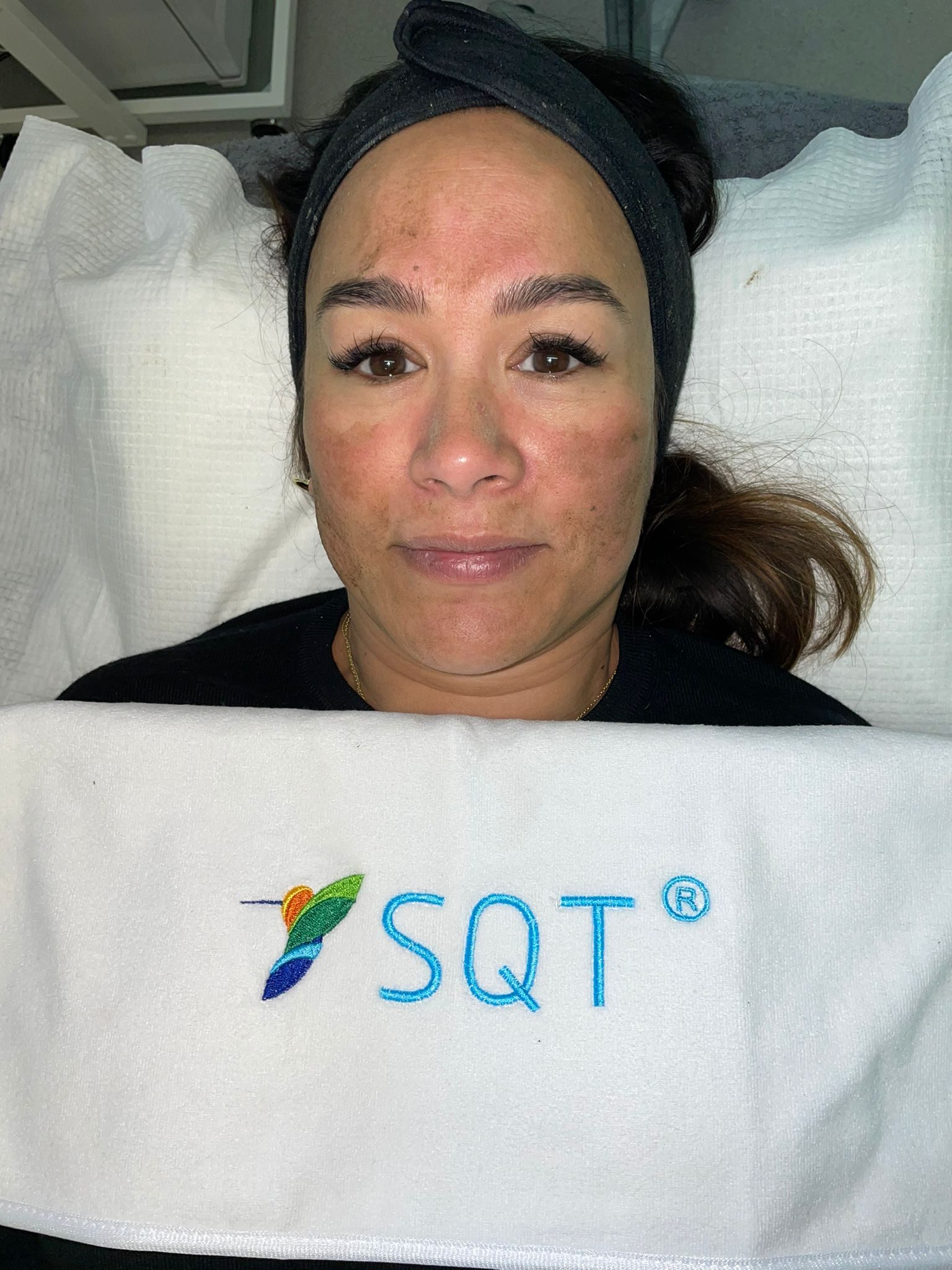 SQT – Brand New Microneedling Revolution