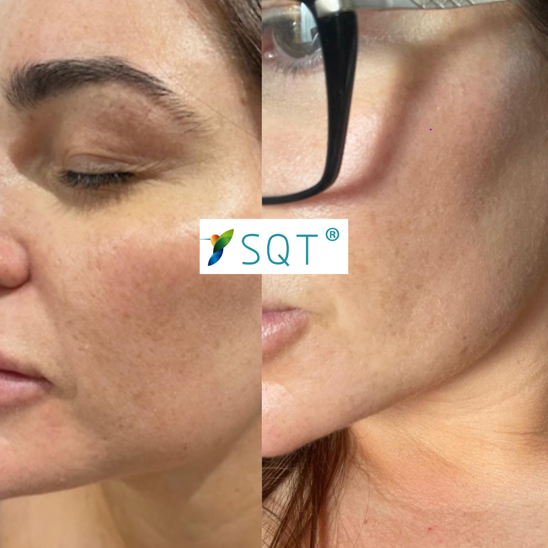 SQT UK Bio Microneedling - SQT UK