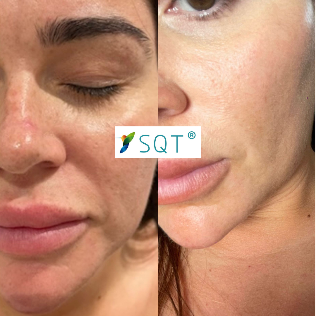 SQT UK Bio Microneedling - SQT UK