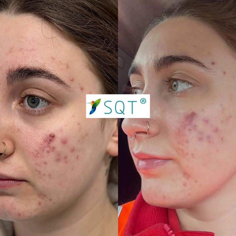 SQT UK Bio Microneedling - SQT UK