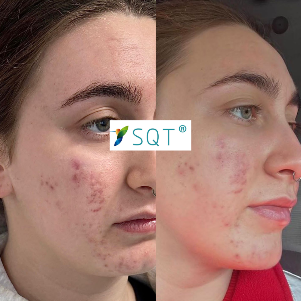 SQT UK Bio Microneedling - SQT UK