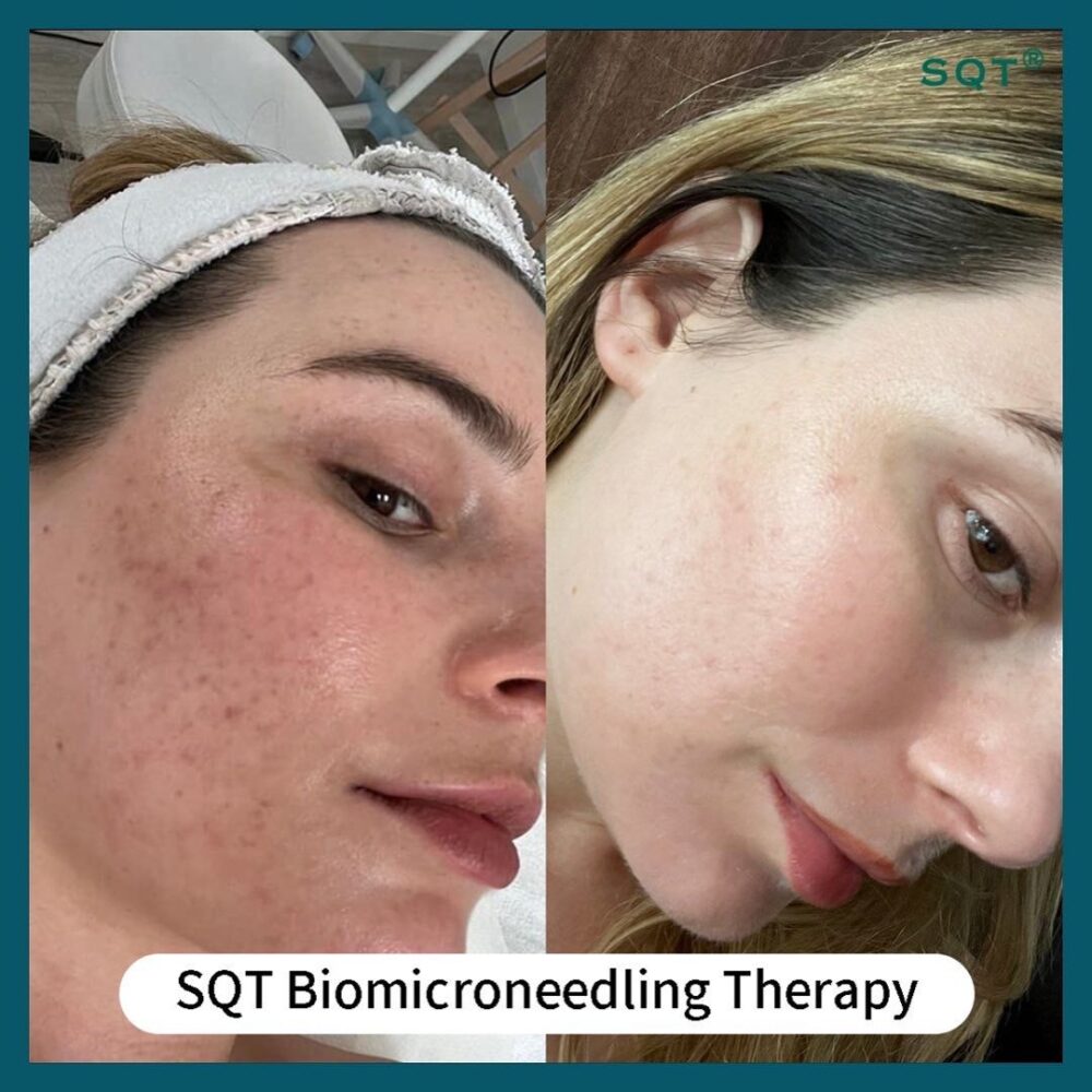 SQT UK Bio Microneedling - SQT UK